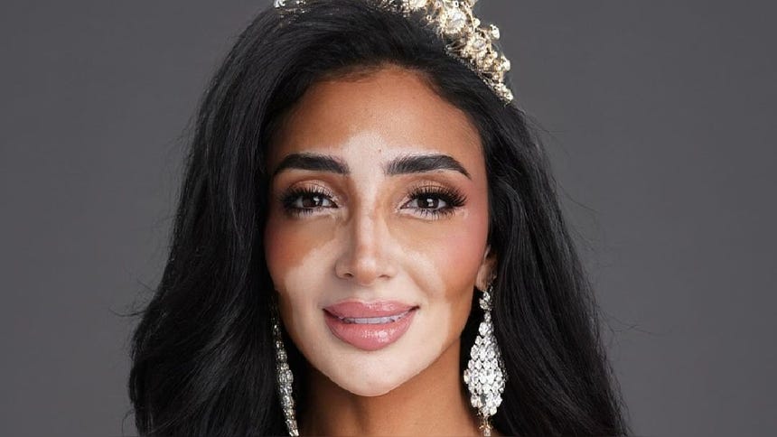 Miss Egipto es la primera aspirante al Miss Universo con vitiligo
